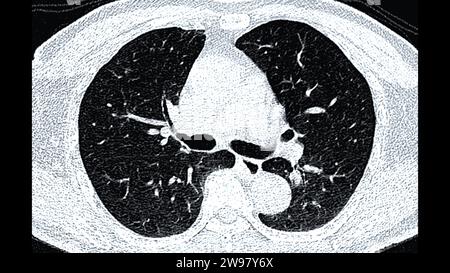 CT scan of Chest or lung for screening lung nodules and lung cancer ...