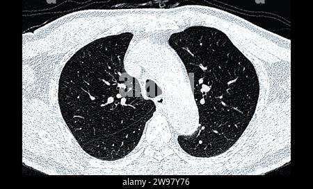 CT scan of Chest or lung for screening lung nodules and lung cancer ...