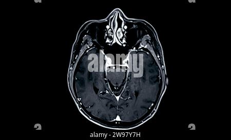 MRI brain scans axial view offer valuable insights into brain anatomy ...