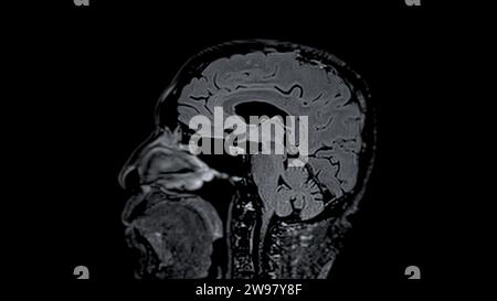 MRI brain scans sagittal view offer valuable insights into brain ...