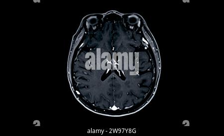 MRI brain scans axial view offer valuable insights into brain anatomy ...