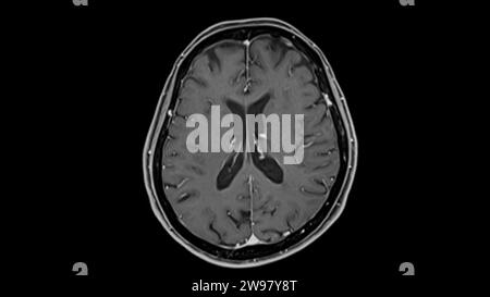 MRI brain scans axial view offer valuable insights into brain anatomy ...