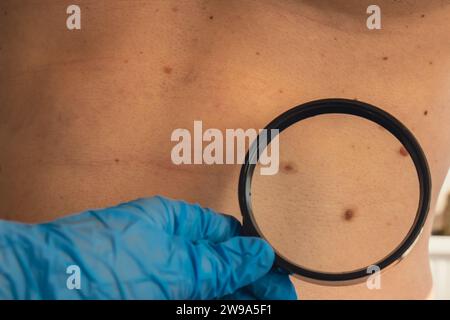 Mole dermoscopy, preventive of melanoma. Dermatologist examining ...