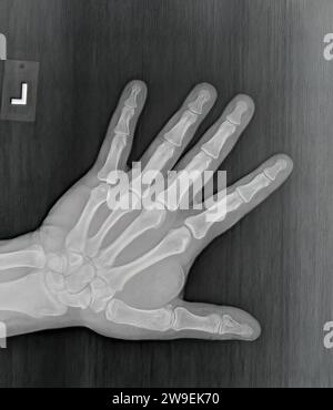 Film x ray or radiograph of a normal adult lumbar vertebrae anterior ...