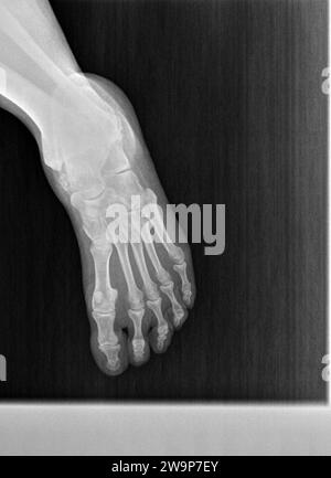 Film xray or radiograph of a normal foot, ankle and leg. Lateral view ...