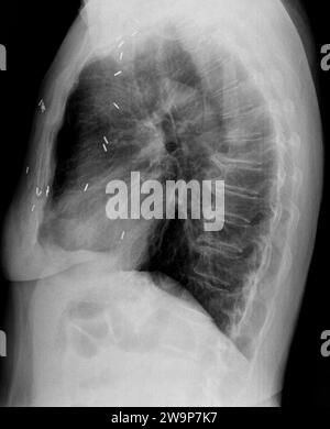 Film xray or radiograph of a mid back thoracic vertebrae . Lateral side ...