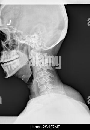 Film xray or radiograph of a cervical neck. Lateral side view showing ...