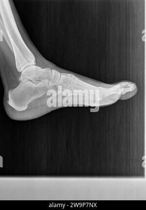 Film xray or radiograph of a normal foot, ankle and leg. dorsal ...
