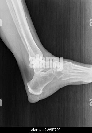 Film xray or radiograph of a normal foot, ankle and leg. Lateral view ...