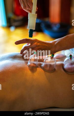 Usage of acupuncture points in a modern clinic. Woman receiving cupping ...