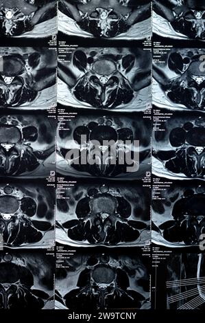 Cairo, Egypt, December 24 2023: L5 Vertebrae Spinal laminectomy ...