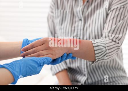 Doctor examining patient's burned hand indoors, closeup Stock Photo - Alamy