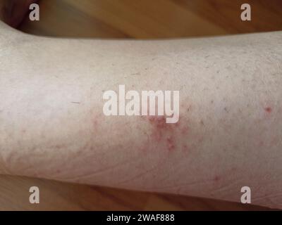 rash eczema dermatitis on leg. inflammation of skin Stock Photo - Alamy