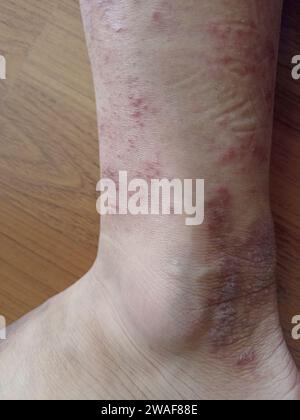rash eczema dermatitis on leg. inflammation of skin Stock Photo - Alamy