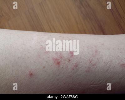 rash eczema dermatitis on leg. inflammation of skin Stock Photo - Alamy