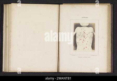 Skin rash caused by syphilis, A. de Montméja, c. 1860 - c. 1868 ...