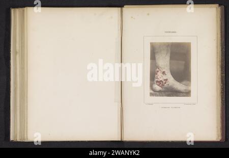 Skin rash caused by syphilis, A. de Montméja, c. 1860 - c. 1868 ...