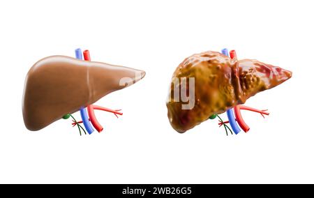 Medical 3d render of liver comparison of healthy one and cirrhosis ...