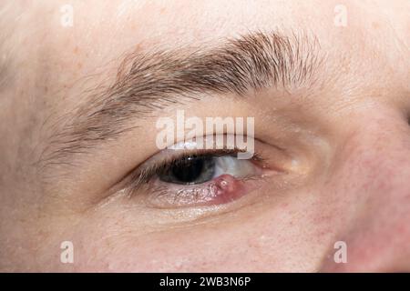Eye of a guy with stye close-up. Acute red purulent inflammation of the ...