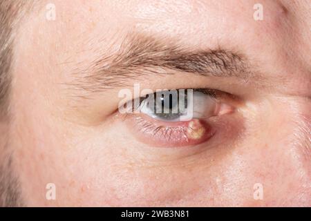 Infected sty barley purulent eye. Man pulls down lower eyelid showing ...
