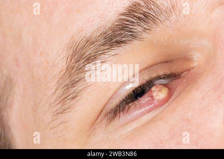 Infected sty barley purulent eye. Man pulls down lower eyelid showing ...