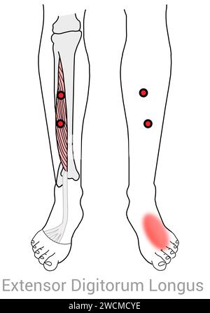 Extensor Digitorum: Myofascial trigger points and associated pain ...