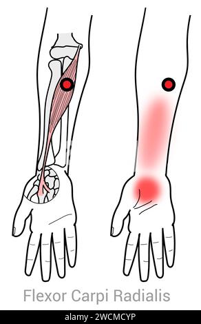 Flexor Carpi Radialis Muscle Stock Photo - Alamy