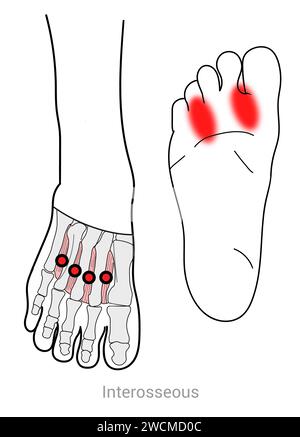 Interosseous muscles: Myofascial trigger points and associated pain ...