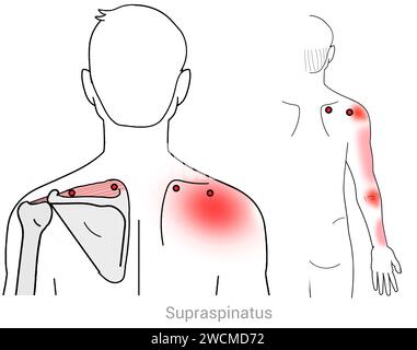 Tricep: Myofascial trigger points and associated pain locations Stock ...