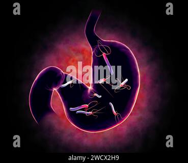 Helicobacter pylori is a gram-negative, flagellated, helical bacterium ...