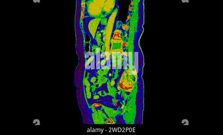 CT scan of Abdomen sagittal view with injection contrast media with ...