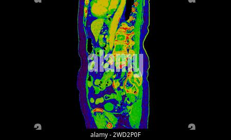 CT scan of Abdomen sagittal view with injection contrast media with ...