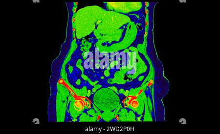 CT scan of Abdomen coronal view with injection contrast media with ...