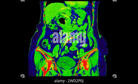 CT scan of Abdomen coronal view with injection contrast media with ...