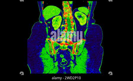 CT scan of Abdomen coronal view with injection contrast media with ...