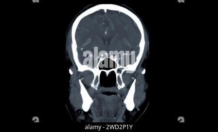 CT scan of the brain Coronal view for diagnosis brain tumor,stroke ...