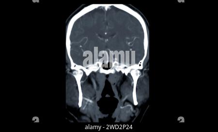 CT scan of the brain Coronal view for diagnosis brain tumor,stroke ...