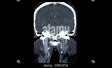 CT scan of the brain Coronal view for diagnosis brain tumor,stroke ...