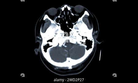 CT scan of the brain Axial view for diagnosis brain tumor,stroke ...