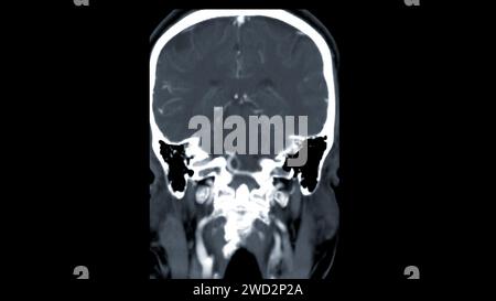 CT scan of the brain Coronal view for diagnosis brain tumor,stroke diseases and vascular ...