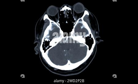 CT scan of the brain Axial view for diagnosis brain tumor,stroke ...