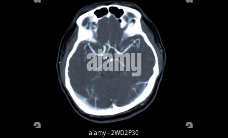 CT scan of the brain Axial view for diagnosis brain tumor,stroke ...