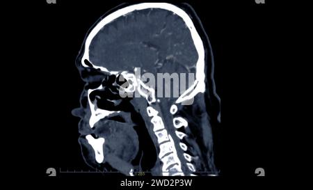 CT scan of the brain sagittal view for diagnosis brain tumor,stroke ...