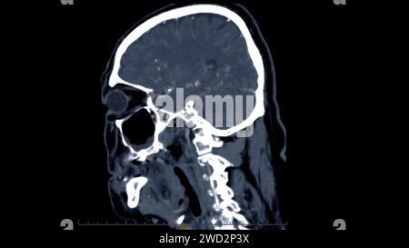 CT scan of the brain sagittal view for diagnosis brain tumor,stroke ...