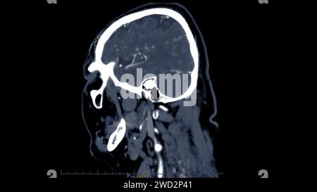 CT scan of the brain sagittal view for diagnosis brain tumor,stroke ...