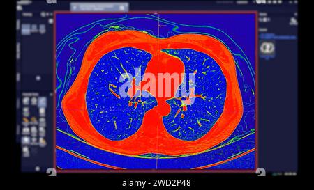 CT scan of Chest or lung axial view for screening lung nodules and lung ...