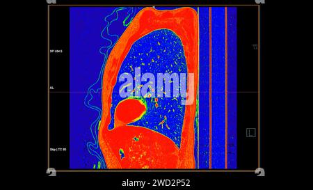 CT scan of Chest sagittal view in color mode for diagnostic Pulmonary ...