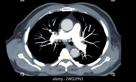 CTPA or CTA pulmonary artery .This imaging technique offers a clear view of the pulmonary ...