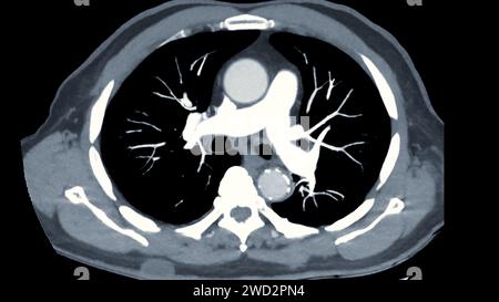 CTPA or CTA pulmonary artery .This imaging technique offers a clear view of the pulmonary ...