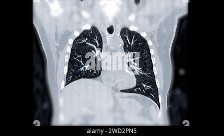 CTPA or CTA pulmonary artery .This imaging technique offers a clear ...